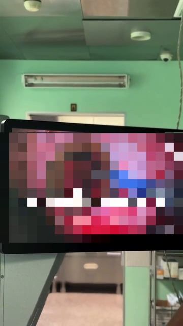 Коррекция высокой степени близорукости