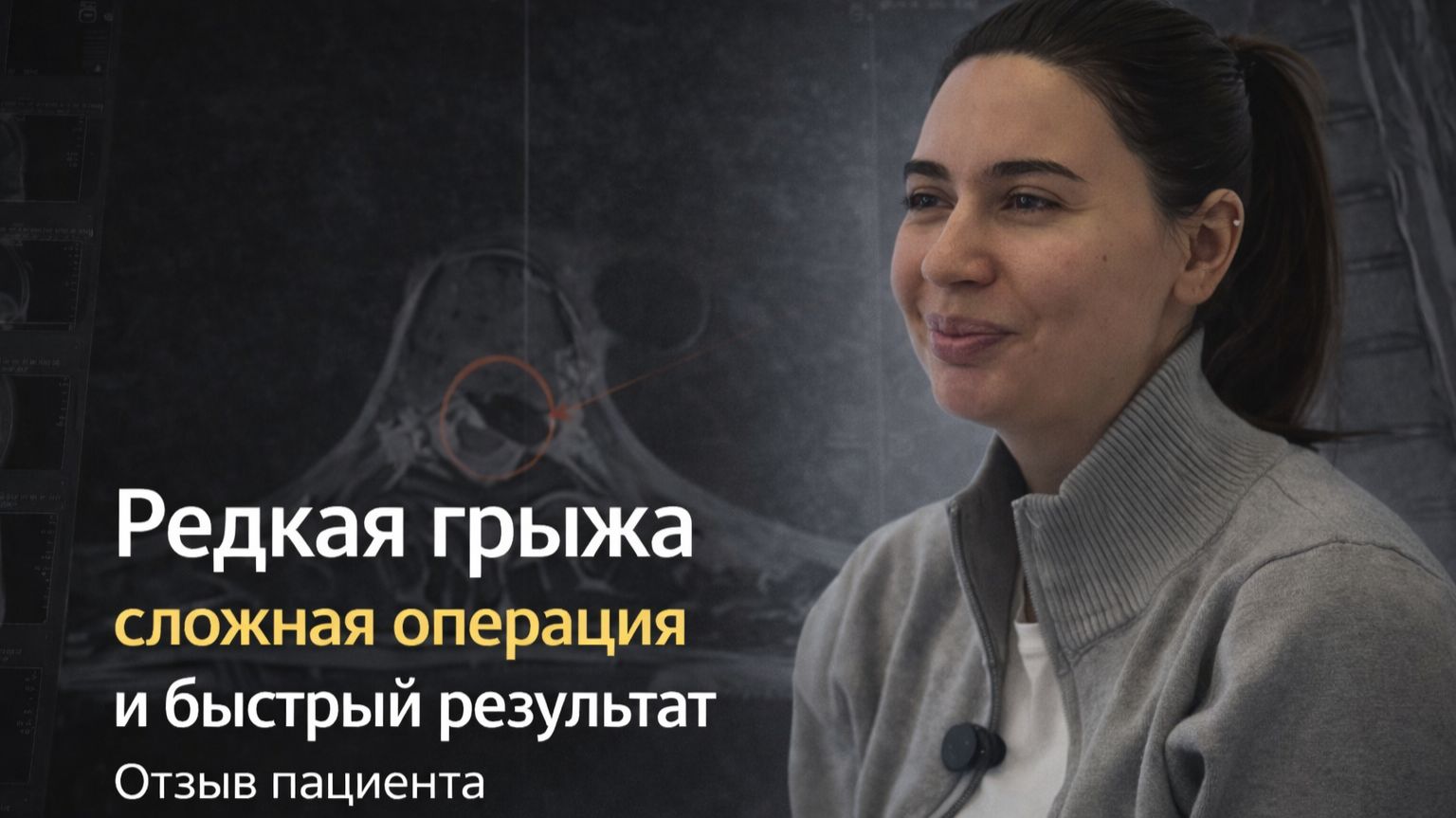 Эндоскопическое удаление оссифицированной грыжи диска грудного отдела Th7-Th8