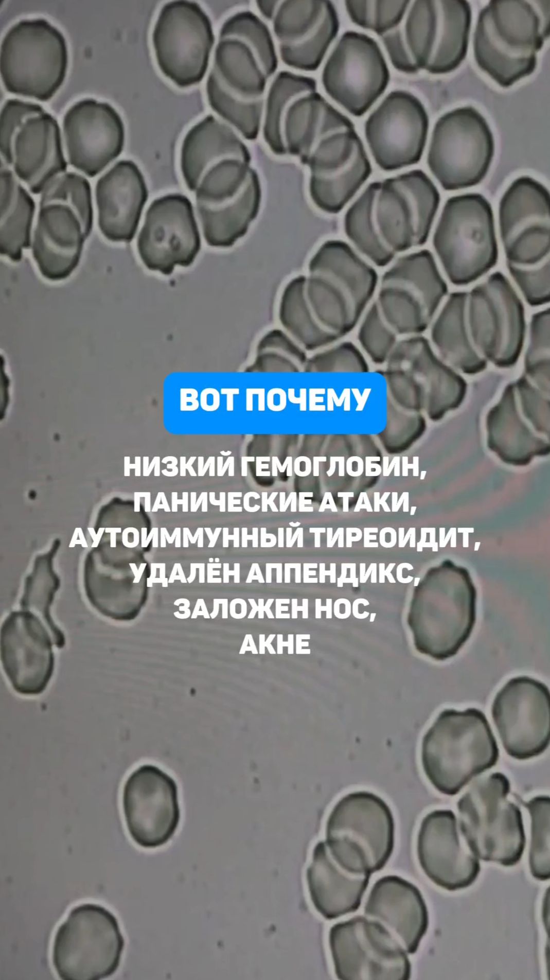 Низкий гемоглобин, панические атаки, аутоиммунный тиреоидит, удален аппендикс, заложен нос, акне