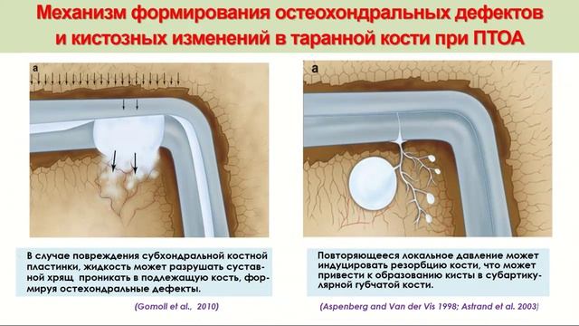 Особенности лечения пациентов с переломами таранной кости и их последствиями.