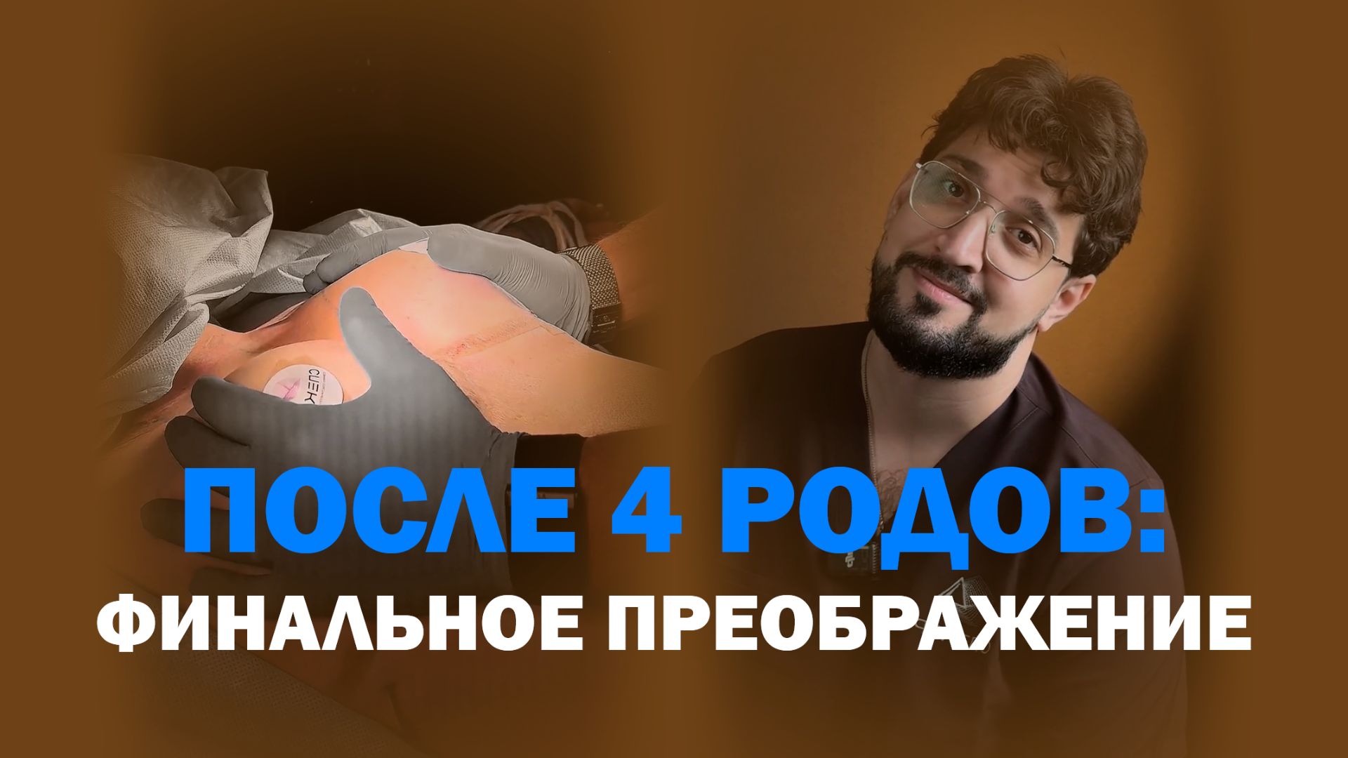 Второй этап преображения: уменьшение и подтяжка груди после абдоминопластики