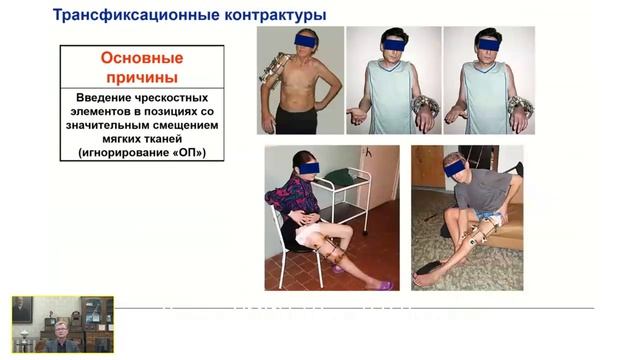 Осложнения при чрескостном остеосинтезе, профилактика и лечение.