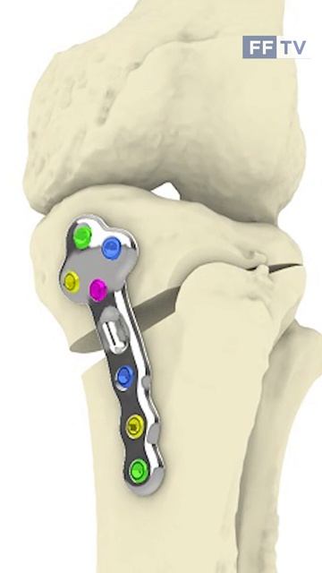 КАК ДАВНО ПОЯВИЛСЯ МЕТОД АДДИТИВНЫХ ТЕХНОЛОГИЙ #здоровье #медицина #хирургия #суставы