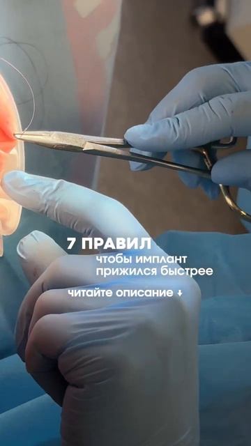 7 правил, чтобы имплант прижился быстрее. Читайте описание  👉
