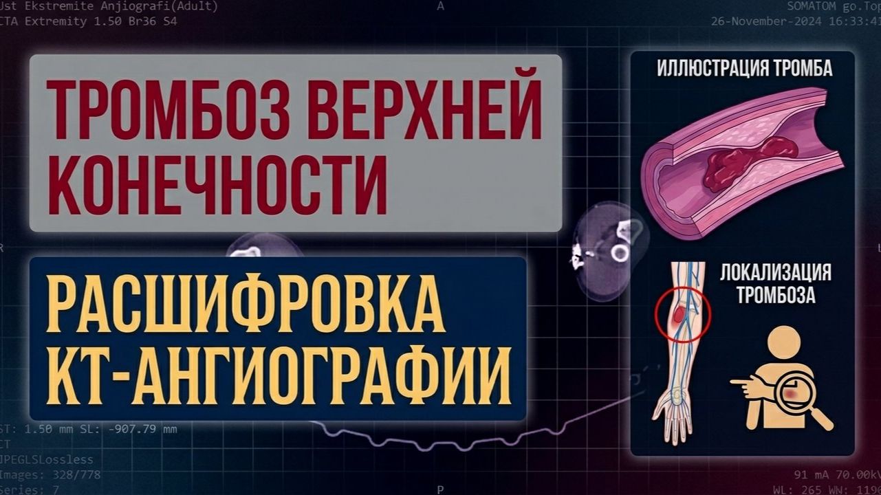 ТРОМБОЗ артерий плеча ОККЛЮЗИЯ, подкожная ЭМФИЗЕМА на РАСШИФРОВКЕ КТ ангиографии верхних конечностей