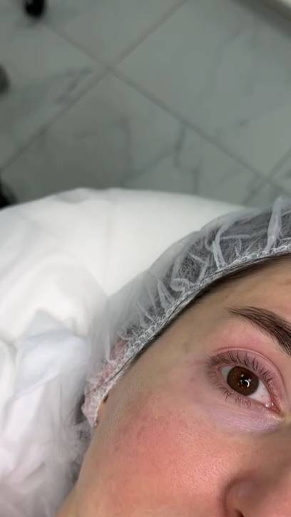 Коррекция синяков под глазами