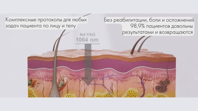 Лазерная система Fotona SP Dynamis
