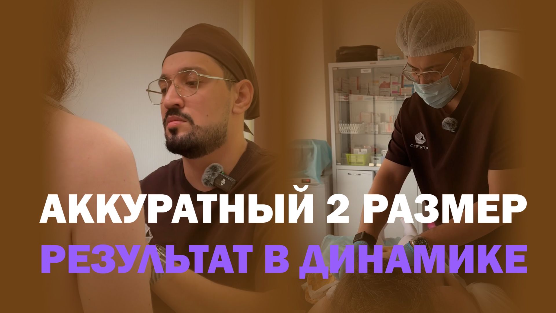 Редукция груди + липосакция подмышек: результат в динамике