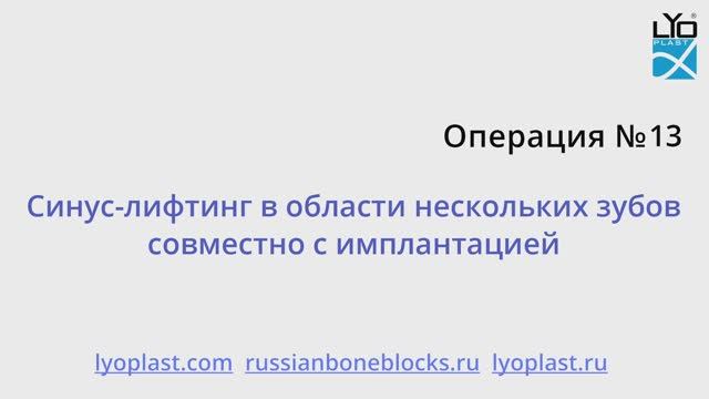 Операция №13 Синус-лифтинг в области нескольких зубов совместно с имплантацией