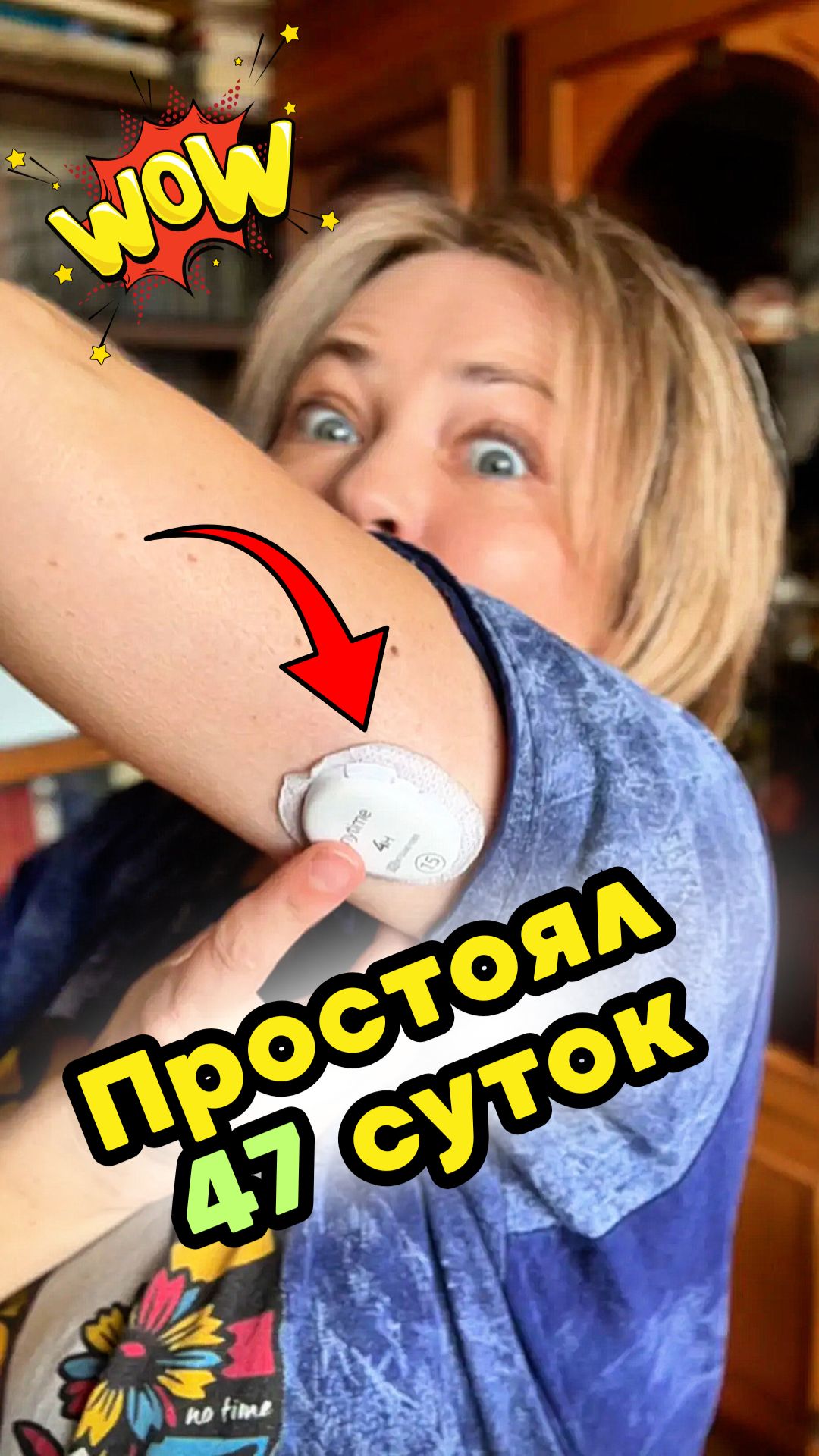 Диабет обзор. Датчик НМГ простоял 47 суток