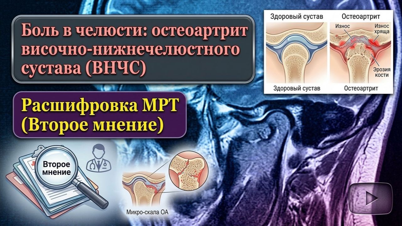 БОЛЬ в ВНЧС при НАРУШЕНИИ ПРИКУСА и АРТРОЗЕ височно-нижнечелюстного сустава на расшифровке МРТ ВНЧС