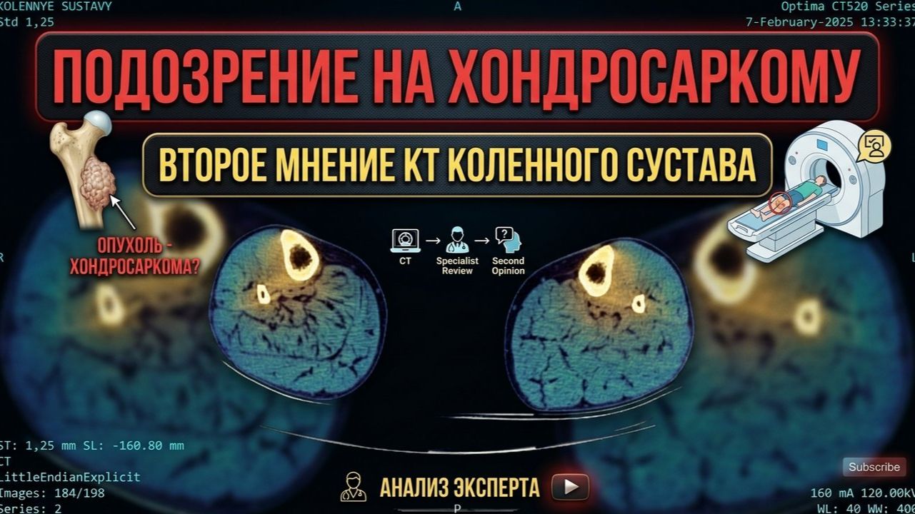 Подозрение на ХОНДРОСАРКОМУ, застарелый РАЗРЫВ МЕНИСКА, ГОНАРТРОЗ 2 степени на РАСШИФРОВКЕ КТ колена