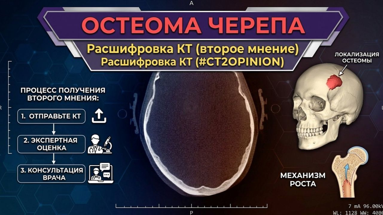 ГОЛОВНАЯ БОЛЬ при ОСТЕОМЕ правой теменной кости на РАСШИФРОВКЕ КТ костей черепа в целом