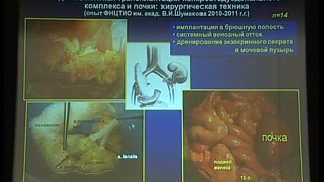 Сахарный диабет 1 типа, диабетическая нефропатия： возможности трансплантологии