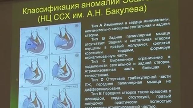 Хирургическое лечение аномалии Эбштейна в сочетании с клеточной терапией аутологичными клетками