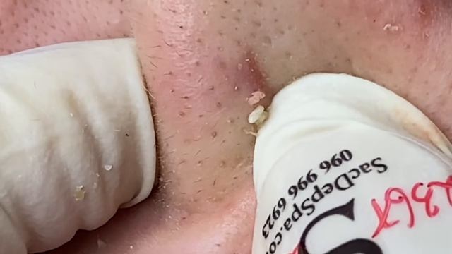 128 • Acne collection • АСМР • Relax Spa