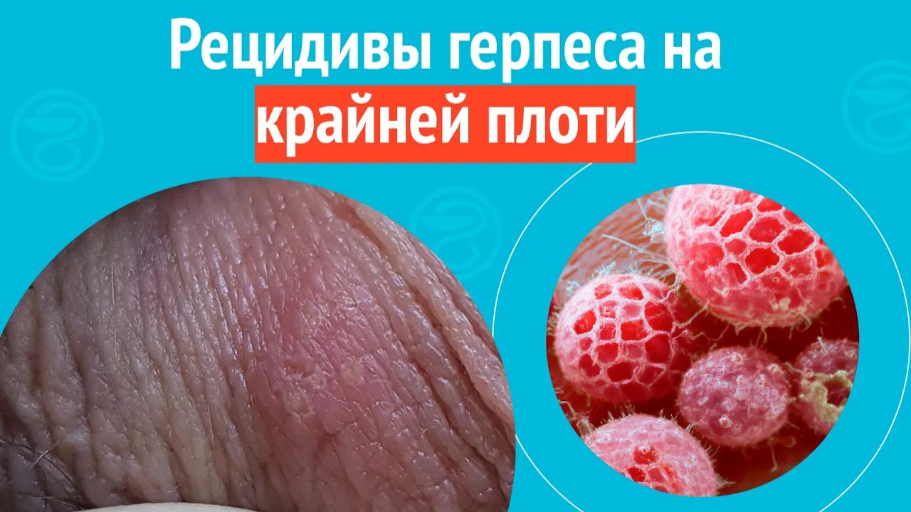 🙁 Рецидивы герпеса на крайней плоти. Клинический случай № 1779