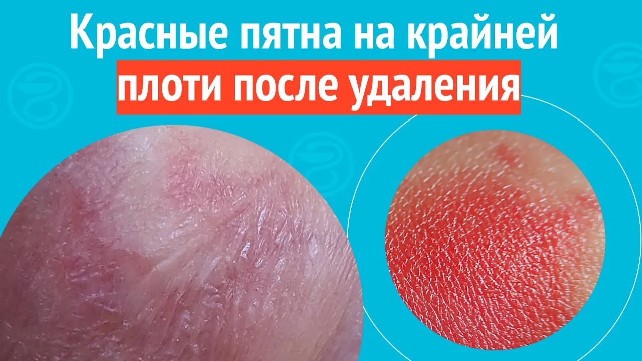 😡 Красные пятна на крайней плоти после удаления. Клинический случай № 1781