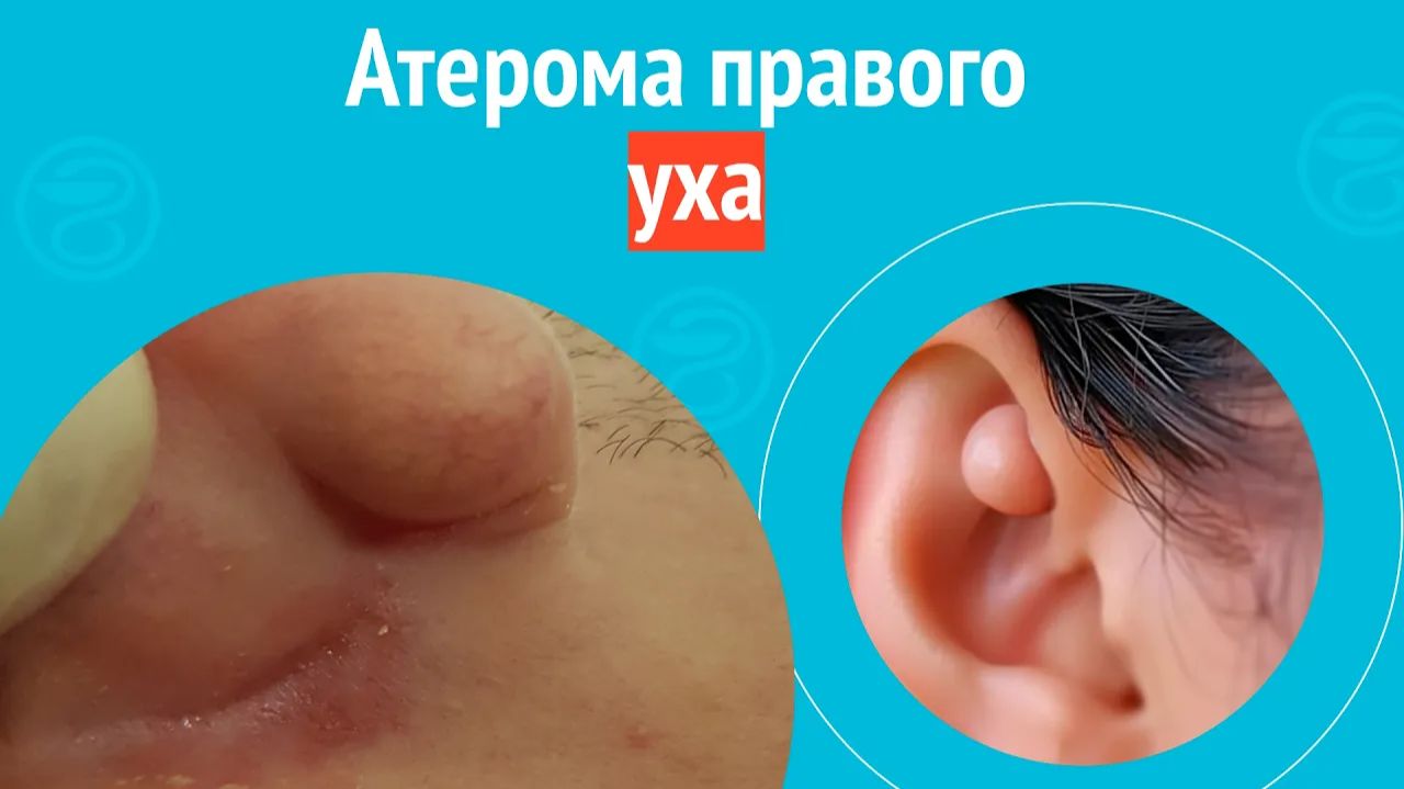 👂Атерома правого уха. Клинический случай № 1780