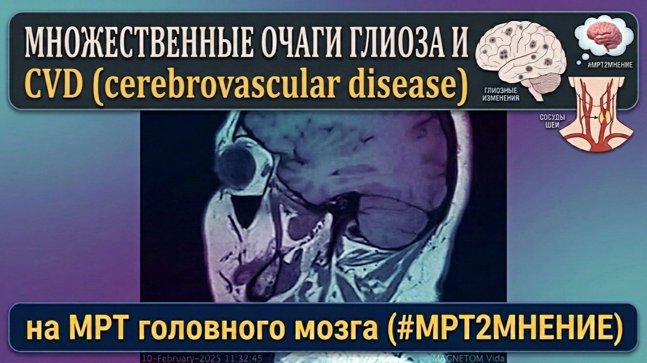 ТЕРЯЕТСЯ ФОКУС зрения при множественных ОЧАГАХ ГЛИОЗА, цереброваскулярной болезни на РАСШИФРОВКЕ МРТ