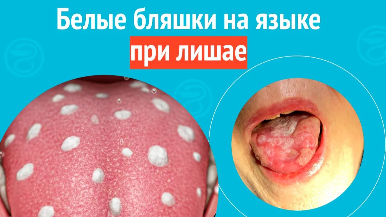 👅 Белые бляшки на языке при лишае. Клинический случай № 1778