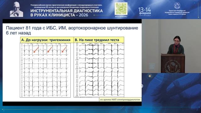 Стратификация желудочковых аритмий, на основании результатов нагрузочных проб у пациентов с ИБС