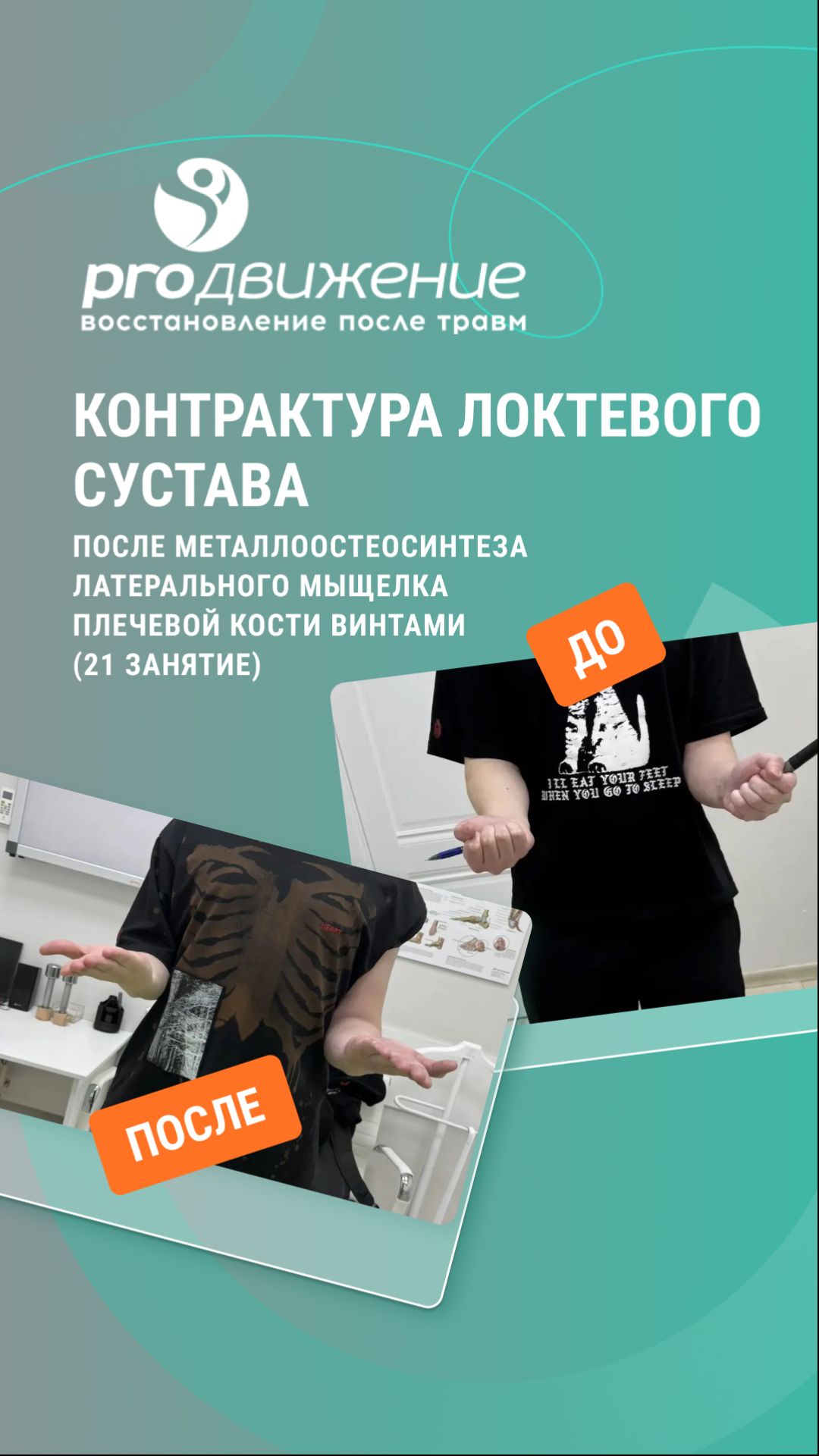 21 занятие — и локоть снова двигается! Реабилитация после остеосинтеза 💪🔄