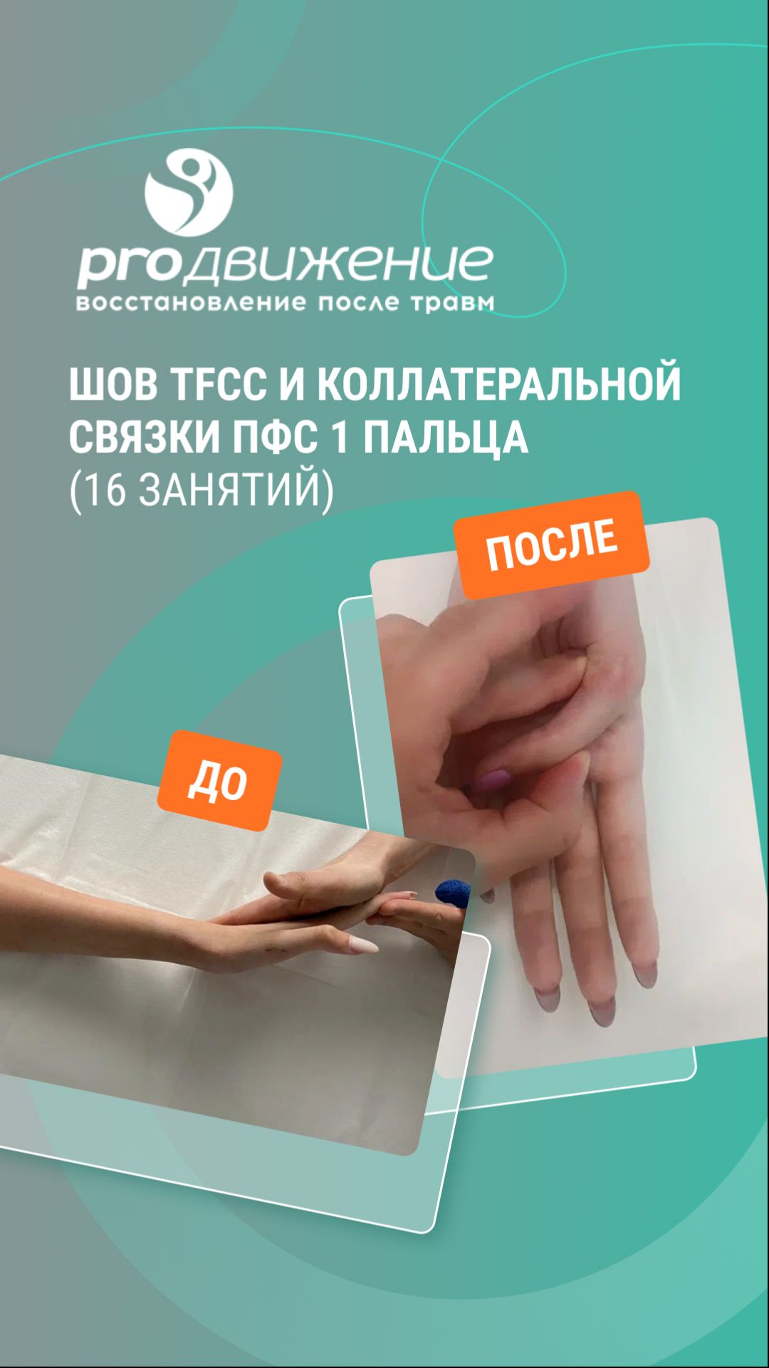 Эффективная реабилитация: как вернуть кисть и вернуться к профессиональному волейболу