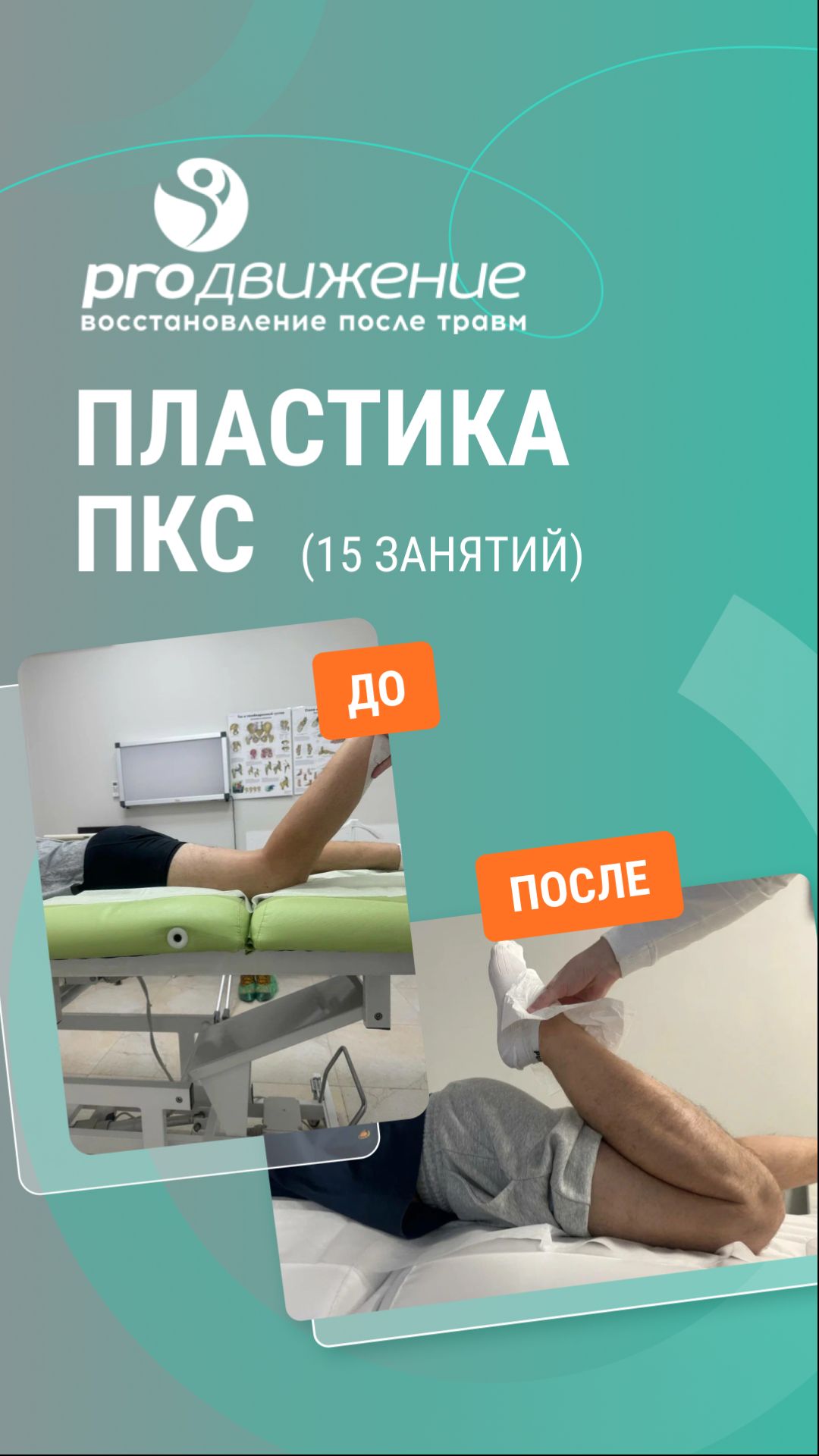 🩺 Реабилитация после пластики передней крестообразной связки (ПКС)