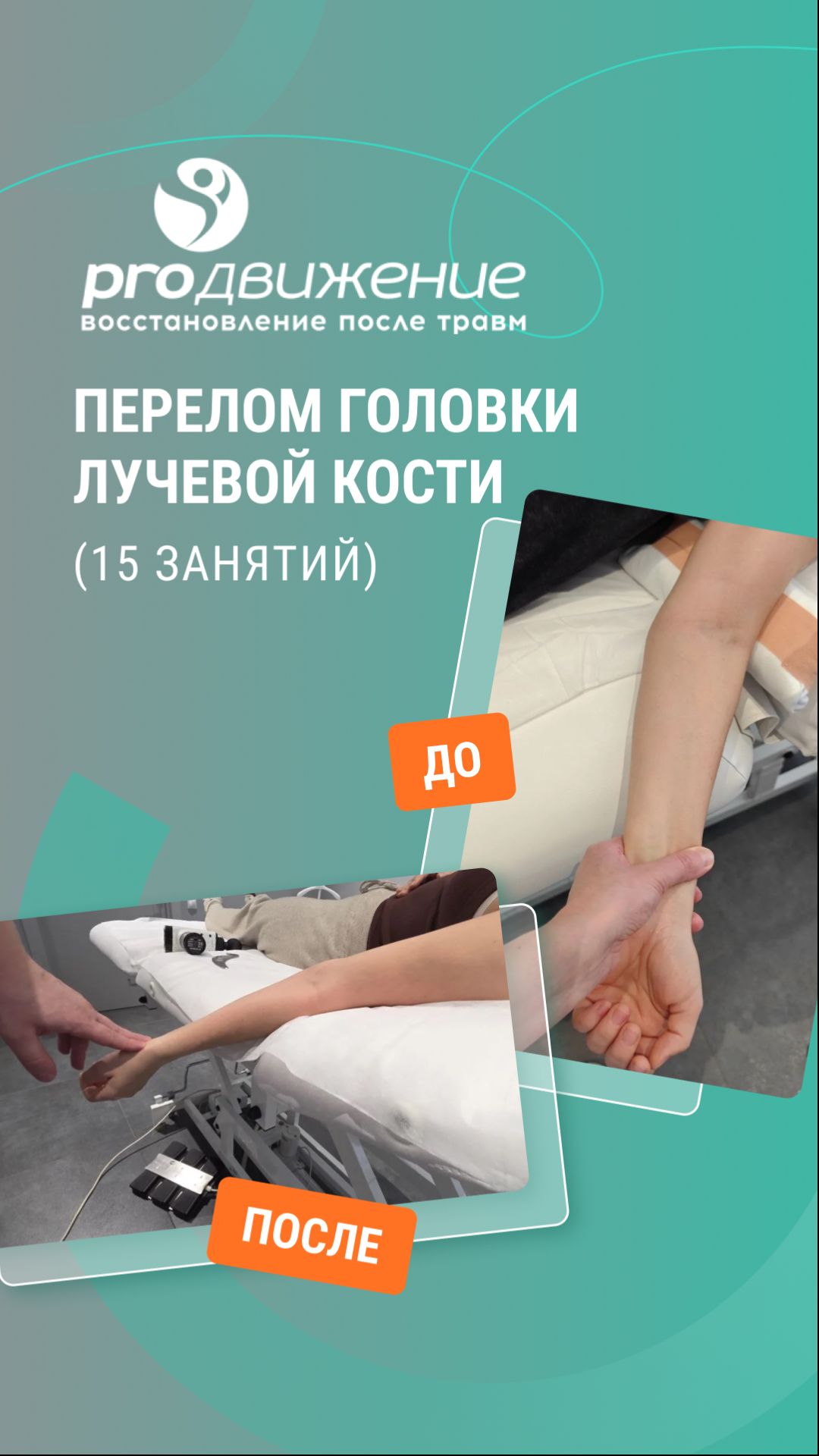15 занятий — и локоть снова работает! Реабилитация после перелома лучевой кости 💪🦾