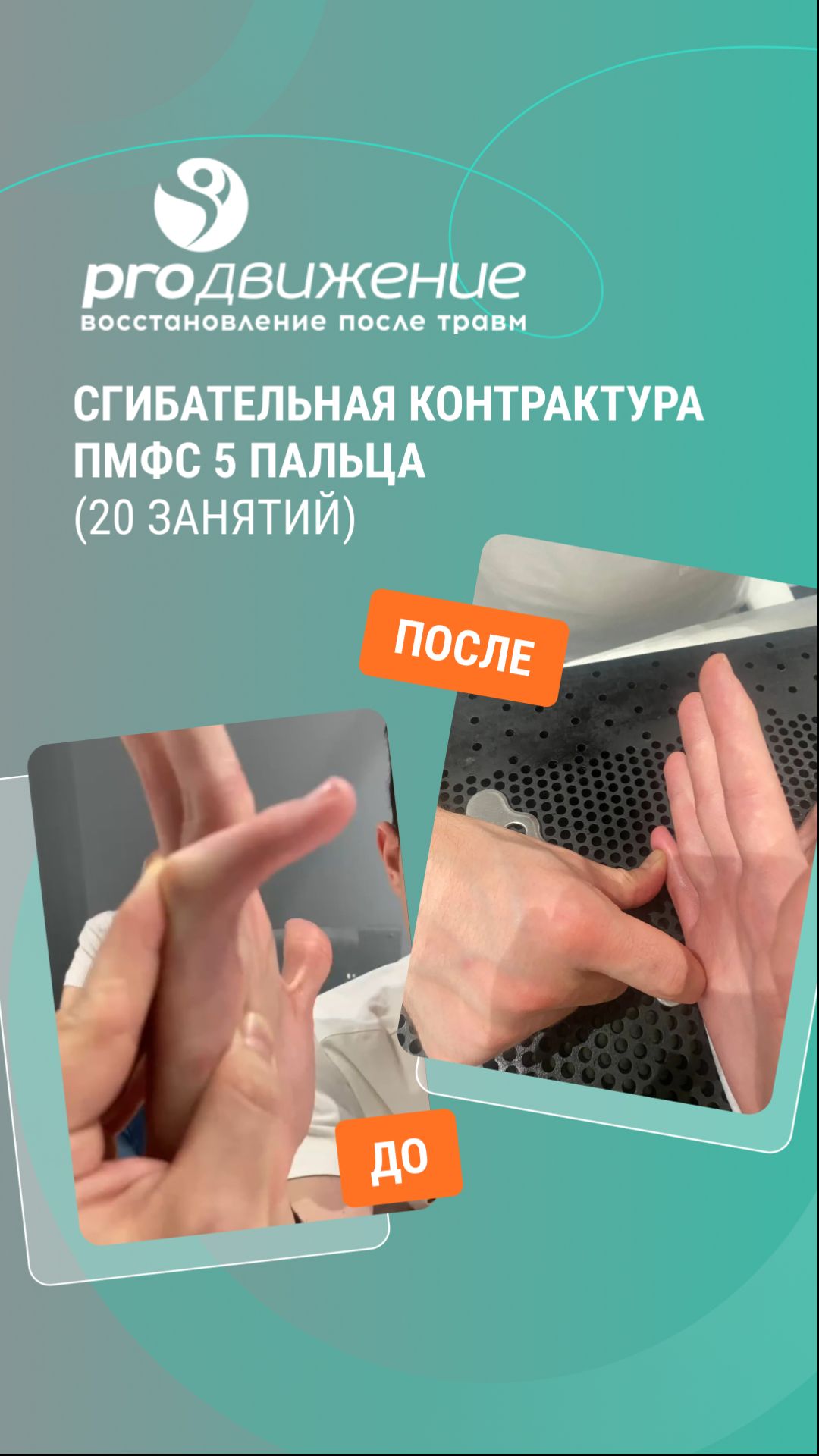 🩺 Клинический случай: реабилитация пациента с контрактурой после повреждения сухожилия сгибателя