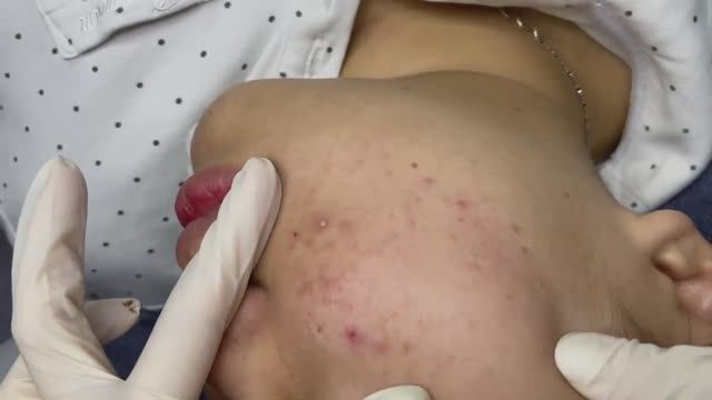 130 • Acne collection • АСМР • Relax Spa