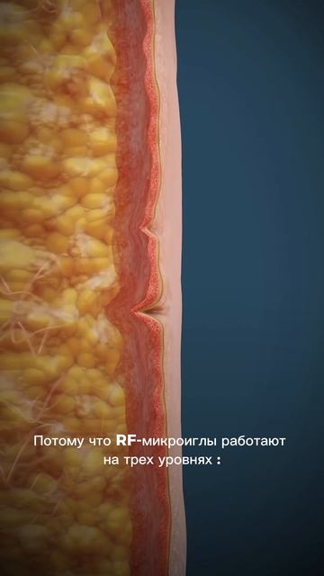 Подтяжка контуров лица: RF-микроигольчатый и контурная пластика