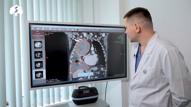 Опухоль 15 см удалили хирурги Сеченовского Университета