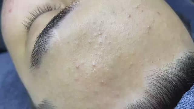 138 • Acne collection • АСМР • Relax Spa