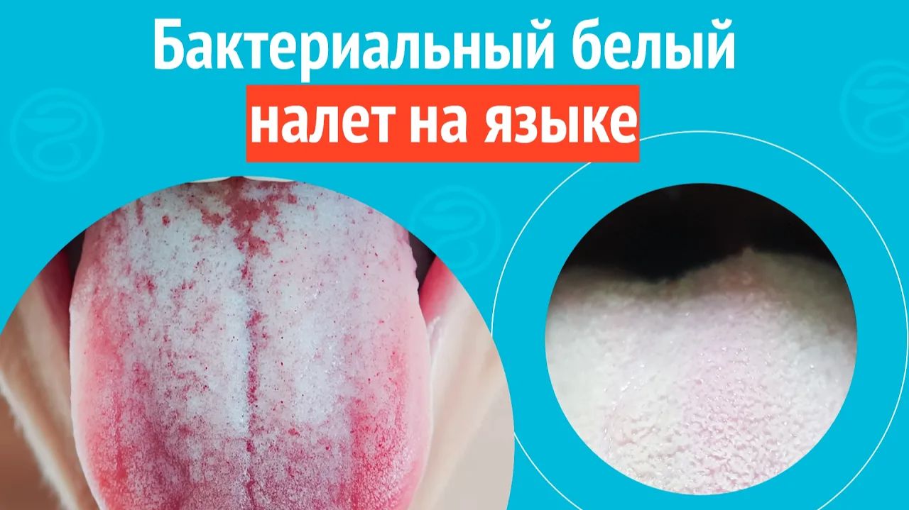 👅 Бактериальный белый налет на языке. Клинический случай № 1785