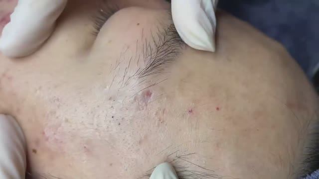 137 • Acne collection • АСМР • Relax Spa