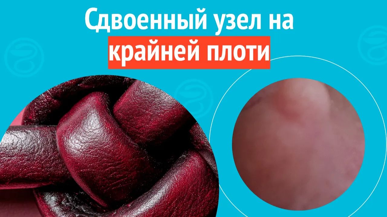 😦 Сдвоенный узел на крайней плоти. Клинический случай № 1784