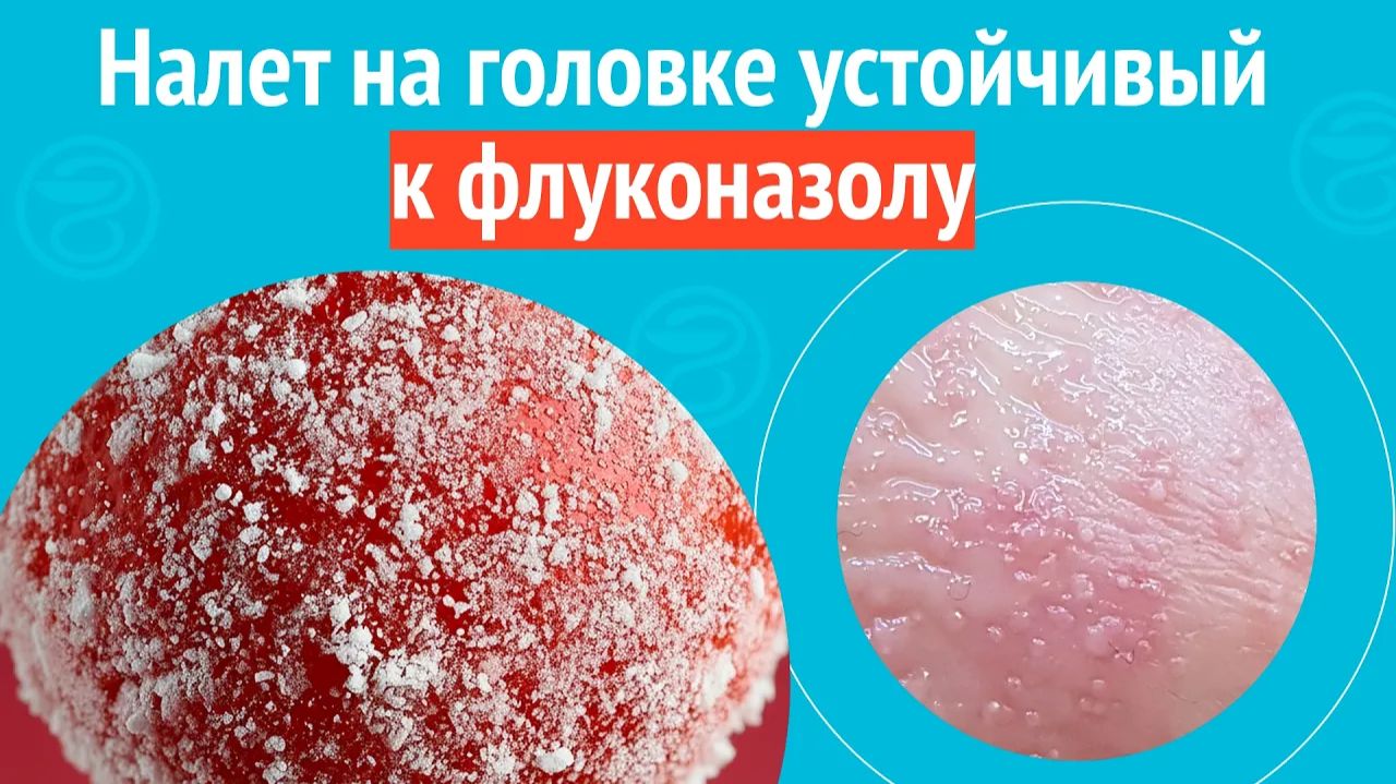 👉 Налет на головке устойчивый к флуконазолу. Клинический случай № 1783