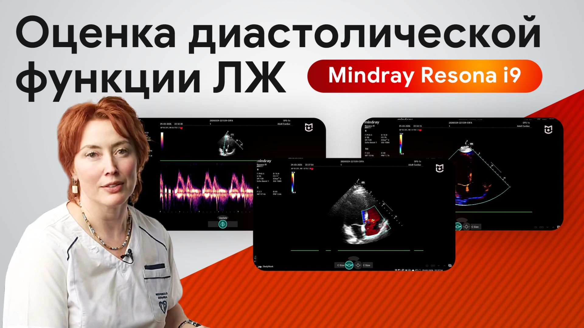 Оценка диастолической функции левого желудочка: ЭхоКГ на Mindray Resona i9