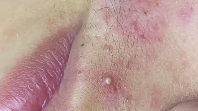 143 • Acne collection • АСМР • Relax Spa