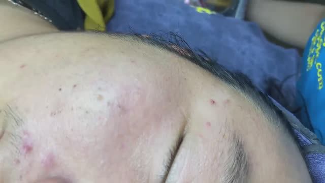 144 • Acne collection • АСМР • Relax Spa