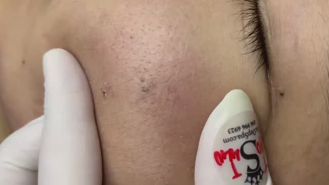 141 • Acne collection • АСМР • Relax Spa