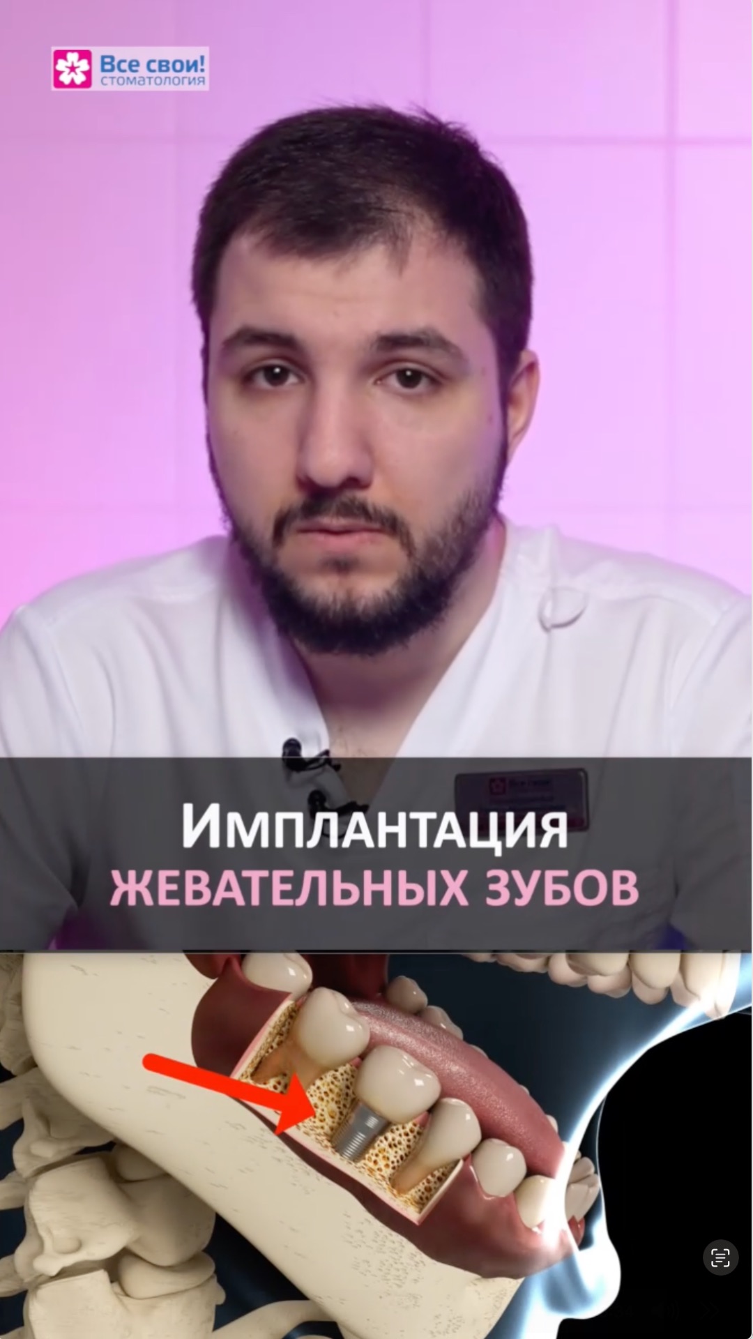 Одноэтапная имплантация жевательных зубов. Можно ли делать немедленную нагрузку на жевательные зубы?