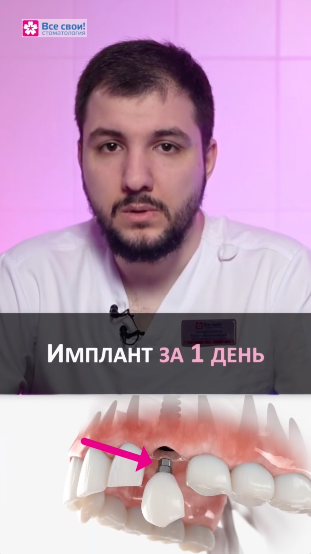 Одноэтапная имплантация vs двухэтапная. Установка импланта сразу после удаления зуба: риски, мифы
