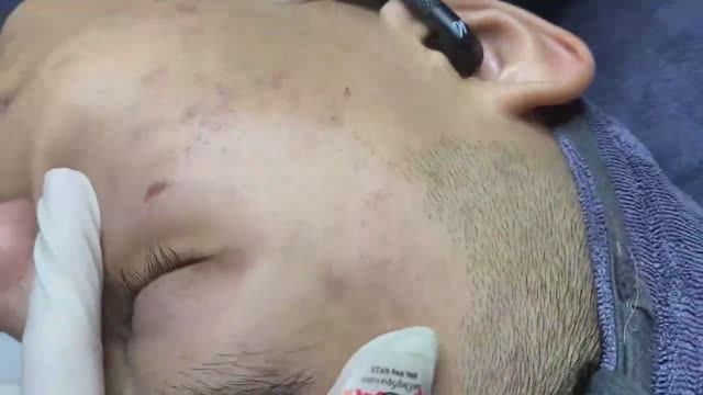 145 • Acne collection • АСМР • Relax Spa