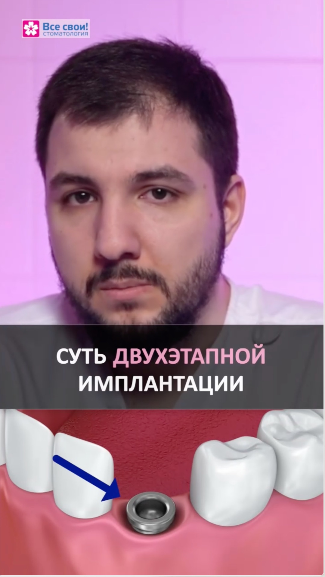 Двухэтапная имплантация зубов: этапы, сроки и суть метода. Почему придется ждать новые зубы полгода