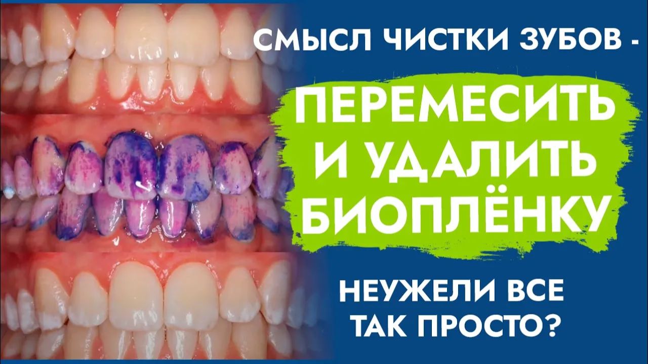 Нет кариеса и пародонтита - все очень просто!