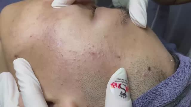 146 • Acne collection • АСМР • Relax Spa