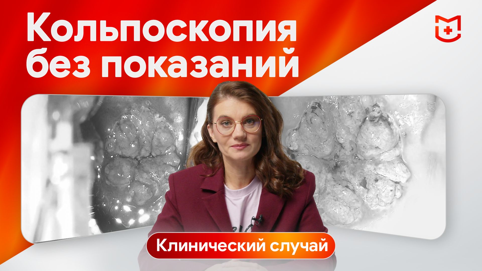 Кольпоскопия без показаний: нужно ли проводить и насколько информативна?